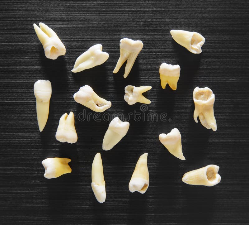 Dientes Extraídos Con Varios Defectos Foto de archivo - Imagen de ...