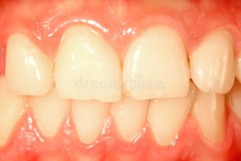 Dientes frontales imagen de archivo. Imagen de muela - 28494585