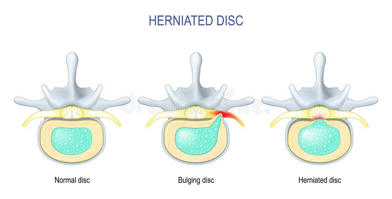 Difference between Bulging Disc and Herniated Disc Stock Vector ...