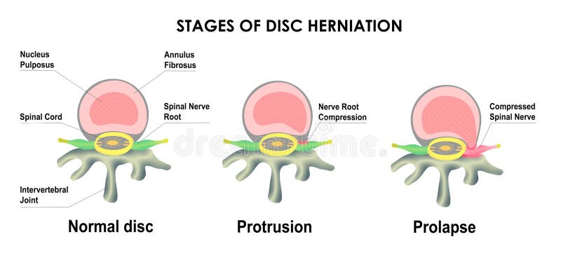 Difference between Bulging Disc and Herniated Disc. Stages of Spinal ...