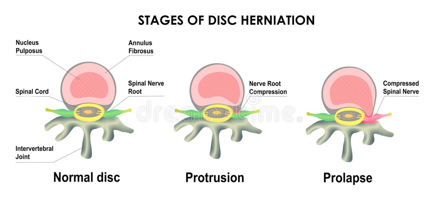 Herniated Disk Stages Stock Illustrations – 15 Herniated Disk Stages ...