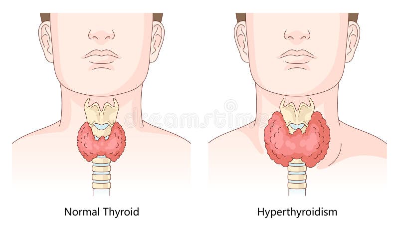 Hyperthyroidism Stock Illustrations – 2,591 Hyperthyroidism Stock ...