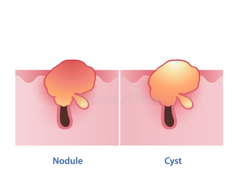 The Difference Between Nodule And Cystic Acne Vector Isolated On White Background Stock