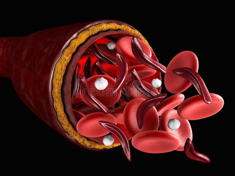 Sickle Cell Anemia, Showing Blood Vessel with Normal and Deformated ...