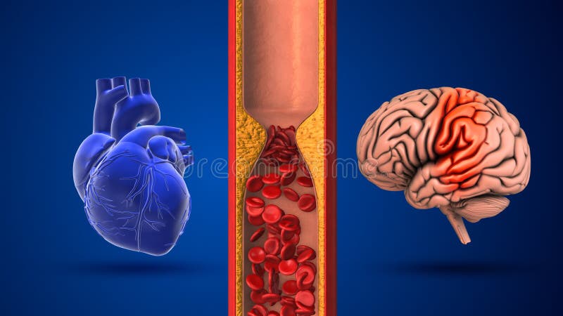 Difference between Stroke and Heart Attack Stock Image - Image of ...