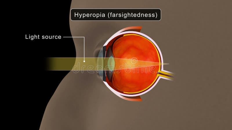 Differences between Hyperopia (farsightedness) and Myopia ...