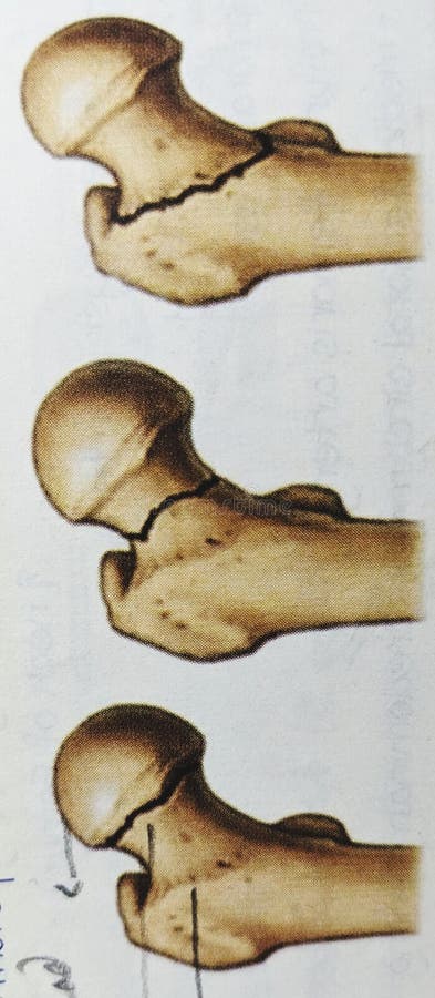 Different Bone Fracture of Neck of Femur Editorial Stock Photo - Image ...