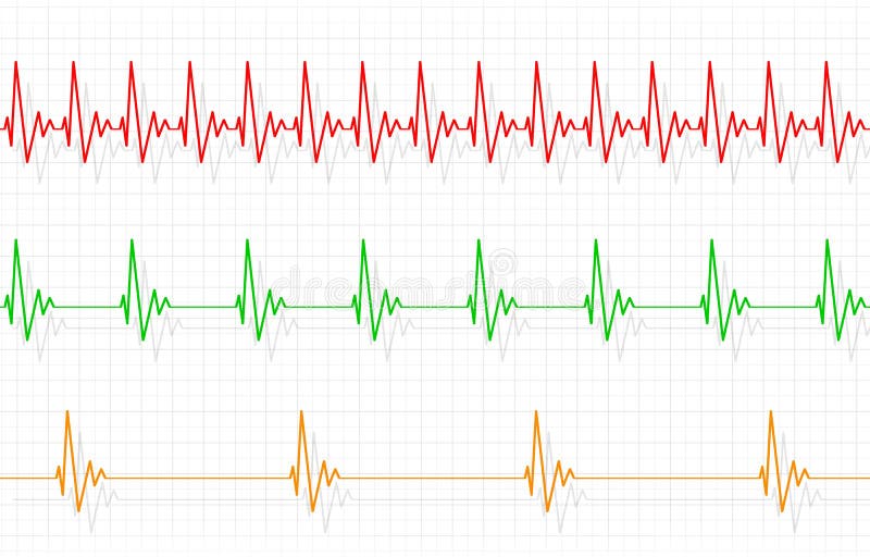 Different Heartbeats Illustration Stock Illustration - Illustration of ...