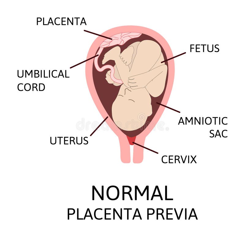 Diagram of Placental Grading. Four Grades from 0 To III Stock ...