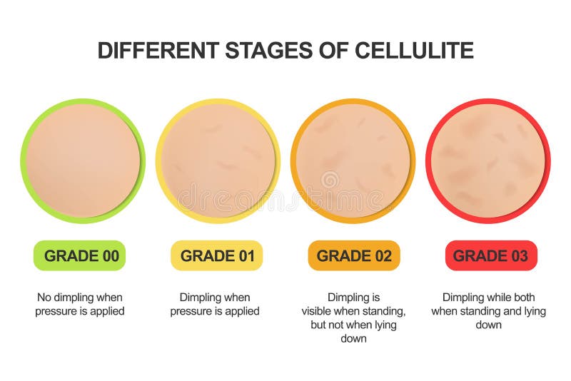 Different Stages of Cellulite. Grading Scale. Treatments. Stock Vector ...