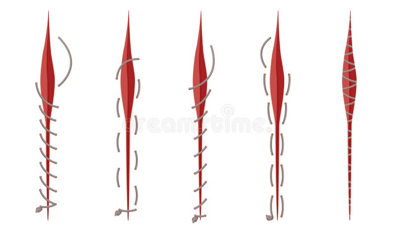 Surgical Stitches Vector Illustration. Labeled Various Cut Injury ...