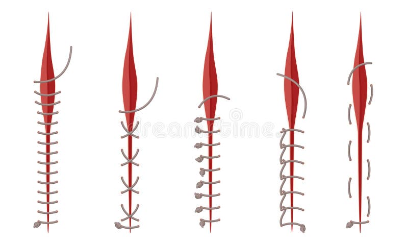 Different Surgical Stitches Isolated on White Background Vector Set ...