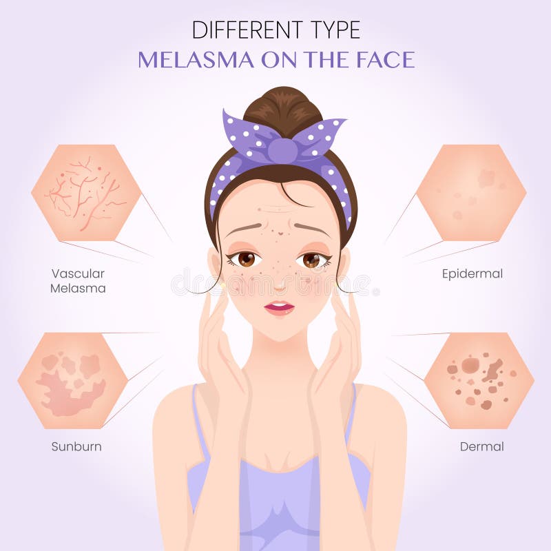 Different Type Melasma on the Face Editorial Stock Photo - Illustration ...