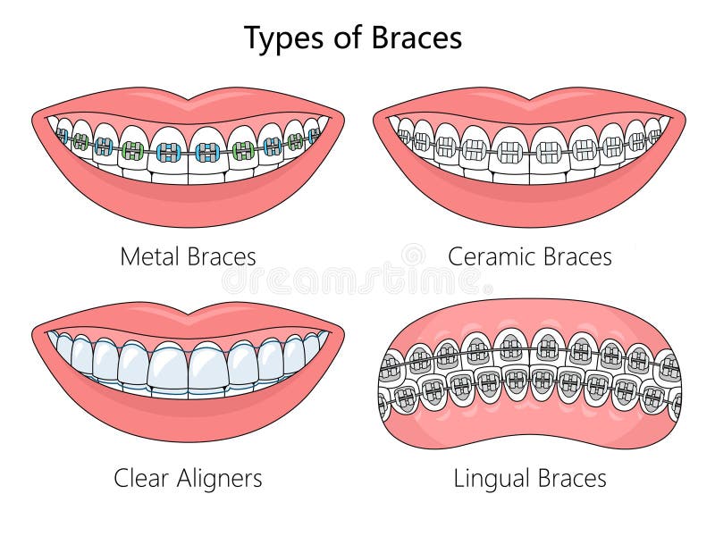 Different Types of Dental Braces Diagram Medical Stock Vector ... Different Types of Dental Braces Diagram Medical Stock Vector ...