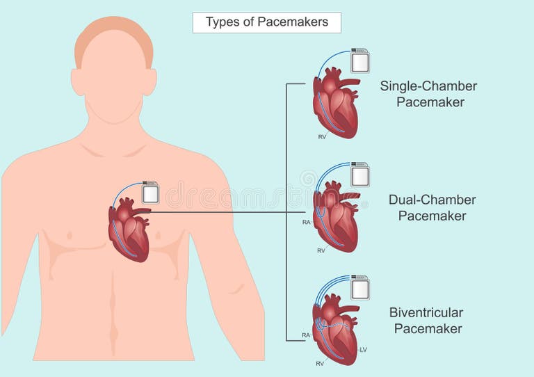 The Different Types of Pacemakers Stock Illustration - Illustration of ...