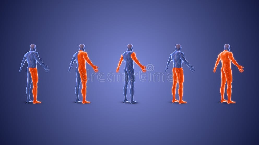 Types Paralysis Stock Illustrations – 13 Types Paralysis Stock ...