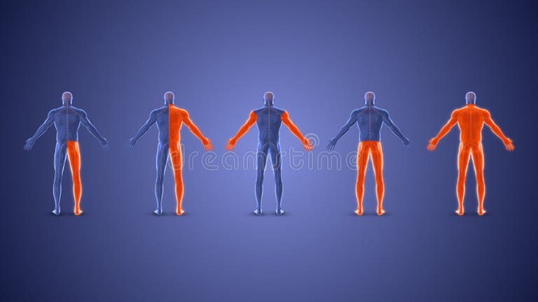 Types Paralysis Stock Illustrations – 13 Types Paralysis Stock ...