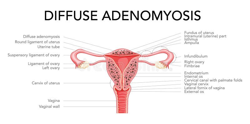 Diffuse Adenomyosis with Inscriptions, Human Anatomy Female ...