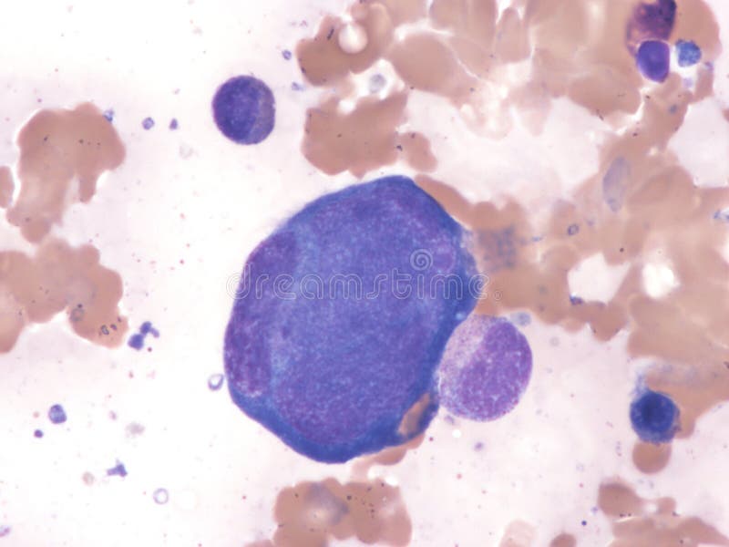 Diffuse Large B Cell Lymphoma, Bone Marrow. Stock Photo - Image of ...