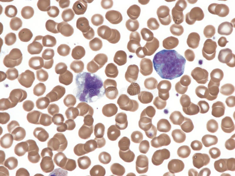 Diffuse Large B-cell Lymphoma in Peripheral Blood. Stock Photo - Image ...