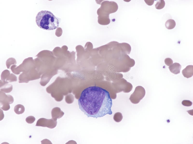 Diffuse Large B Cell Lymphoma, Peripheral Blood. Stock Photo - Image of ...