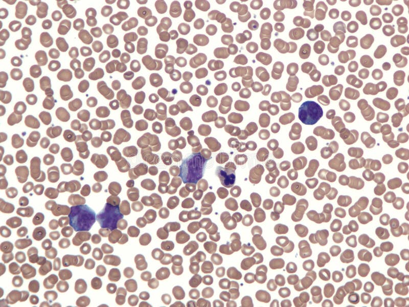 Diffuse Large B-cell Lymphoma in Perpheral Blood. Stock Image - Image ...