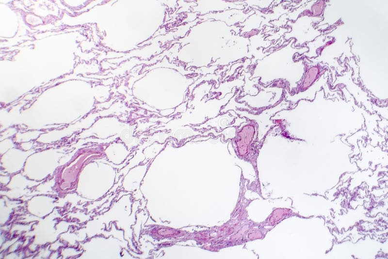 Diffuse Emphysema, Light Micrograph Stock Image - Image of emphysema ...