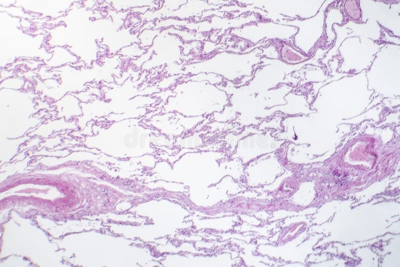 Diffuse Emphysema, Light Micrograph Stock Photo - Image of ...