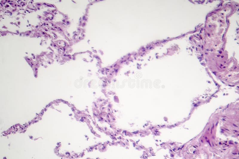 Diffuse Emphysema, Light Micrograph Stock Photo - Image of alveoli ...