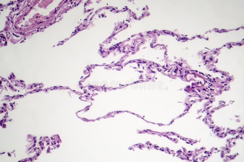 Diffuse Emphysema, Light Micrograph Stock Photo - Image of alveoli ...