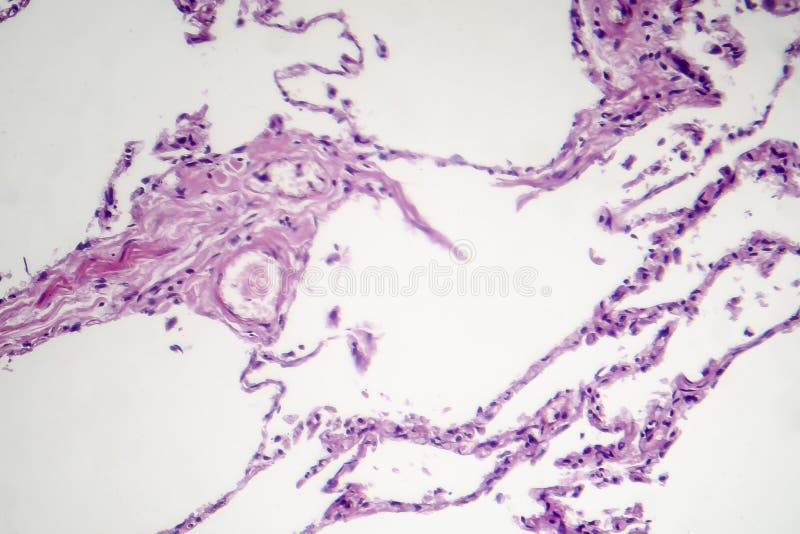 Diffuse Emphysema, Light Micrograph Stock Image - Image of micro ...