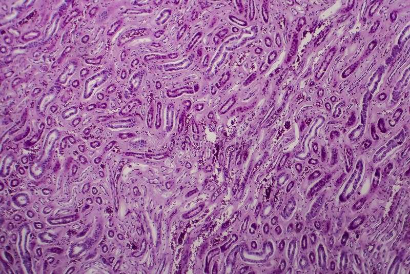 Diffuse Proliferative Glomerulonephritis Stock Image - Image of ...