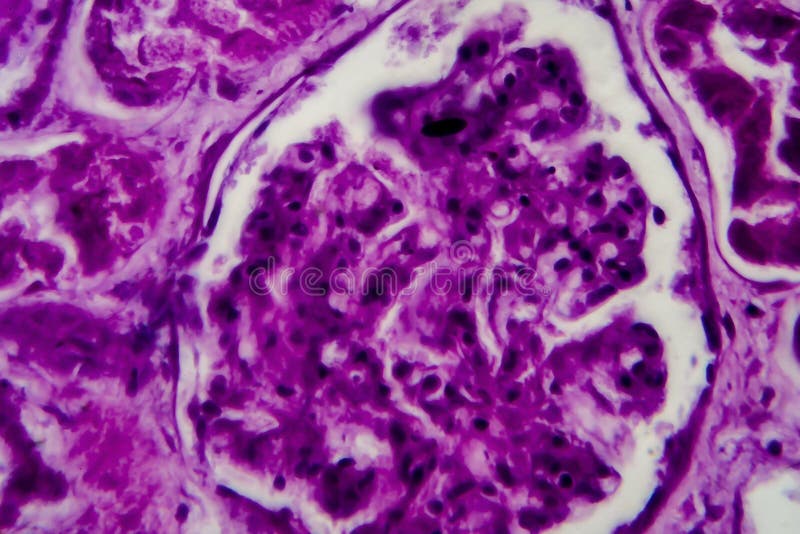 Diffuse Proliferative Glomerulonephritis Stock Photo - Image of ...