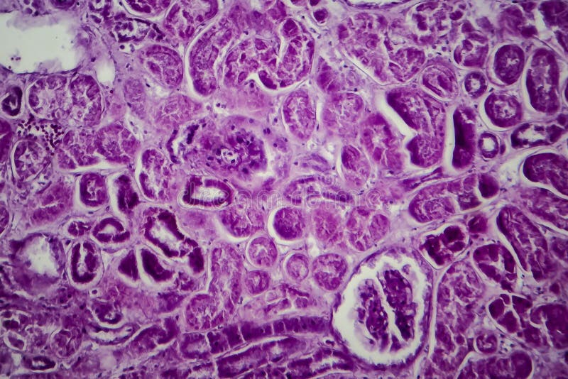 Diffuse Proliferative Glomerulonephritis Stock Photo - Image of renal ...