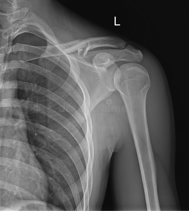 Digital Human Radiograph Showing Shoulder Joint Stock Photo - Image of ...