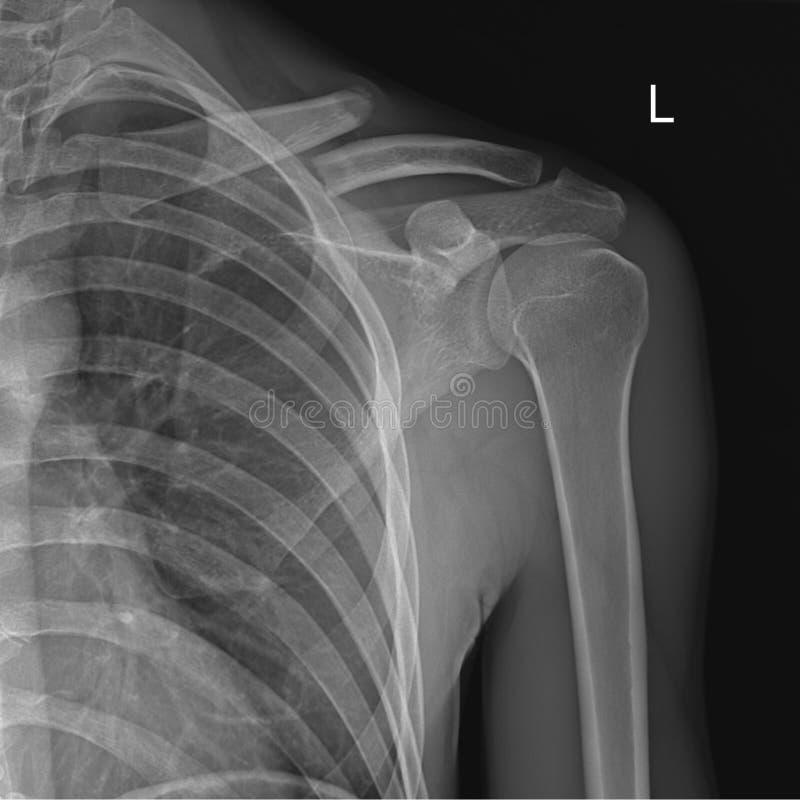 Digital Human Radiograph Showing Shoulder Joint Stock Photo - Image of ...