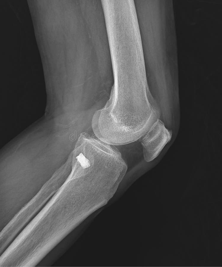 Digital Human X-Ray Knee Joint Stock Image - Image of digital, knee ...