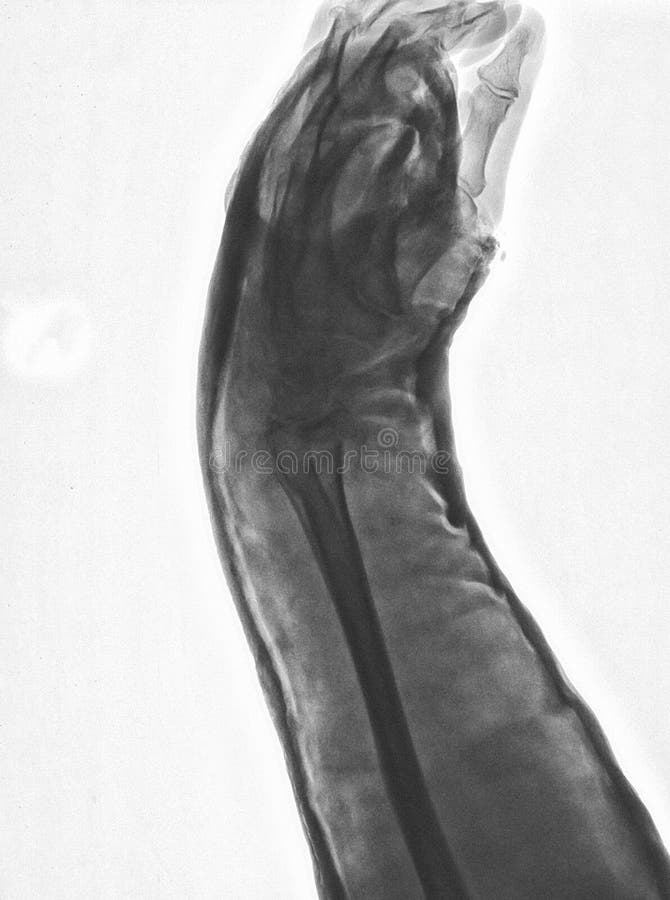 Digital Radiography of Arm and Hand. X Ray of Left Side Stock Image ...