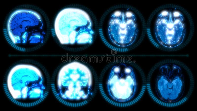 Digital MRI Scan Data of Human Brain Stock Video - Video of treatment ...