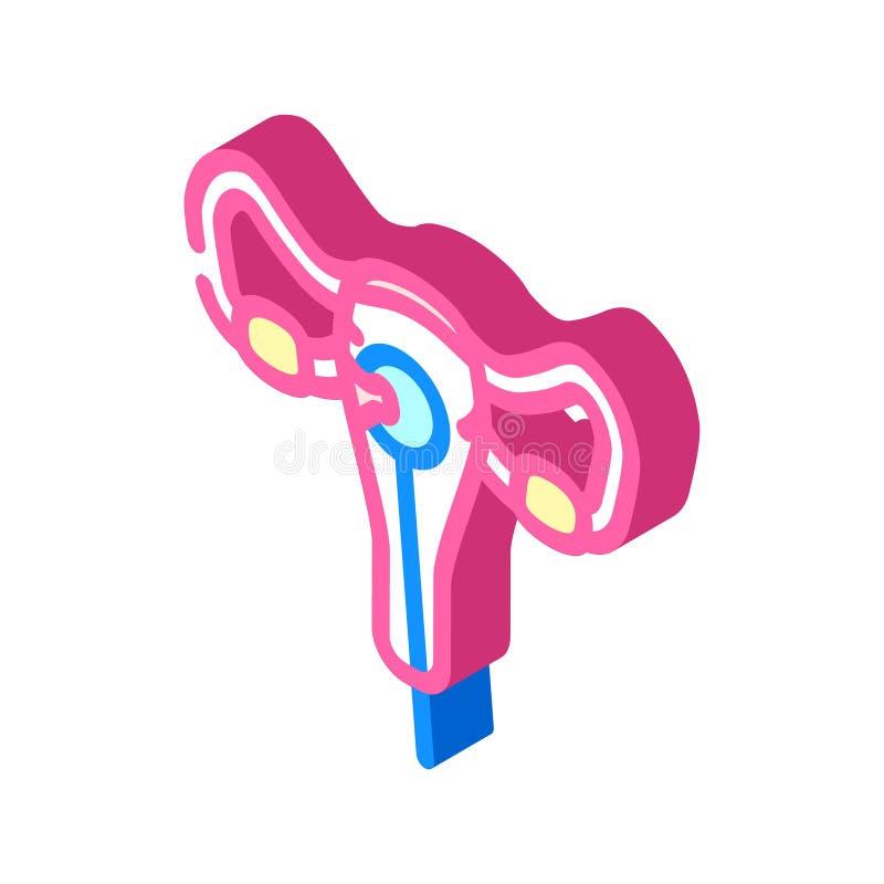 Dilation and Curettage Surgery Isometric Icon Vector Illustration Stock ...