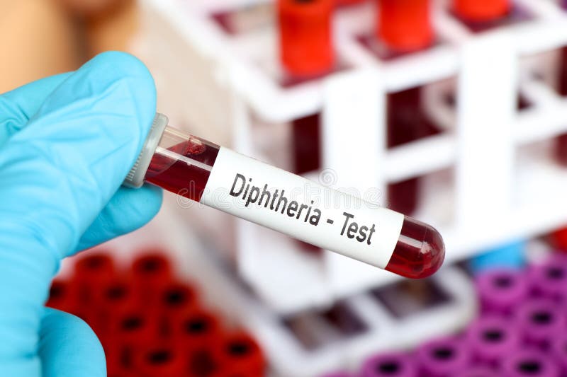 Diphtheria Test, Blood Sample To Analyze in the Laboratory Stock Image ...