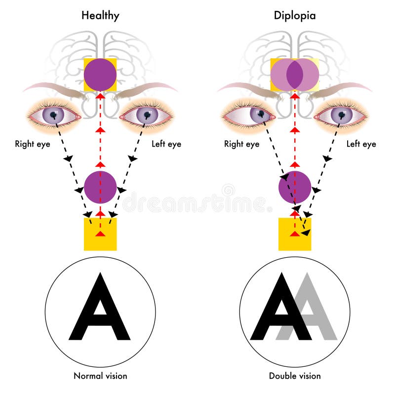 Diplopia stock vector. Illustration of temporary, high - 66537823