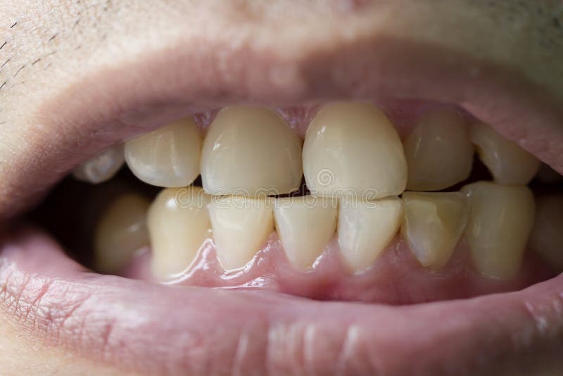 Dirty brown teeth stock photo. Image of decayed, tartar - 158376914
