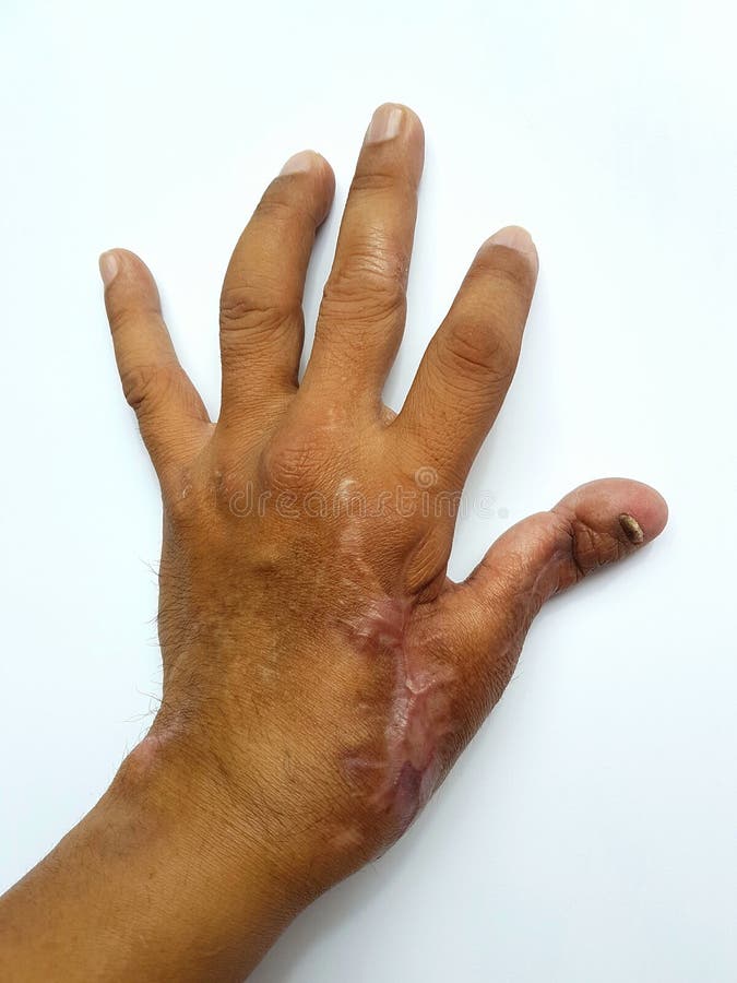 Disabled hand stock image. Image of hand, white, injury - 77544331