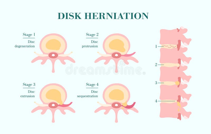 Stages To a Disc Herniation Stock Vector - Illustration of ...