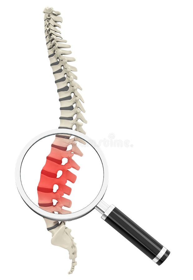 Slipped disc stock illustration. Illustration of spinal - 2077206
