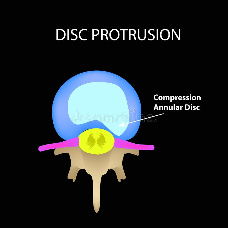 Disc Protrusion. Top View. Spine. Infographics. Vector Illustration on ...
