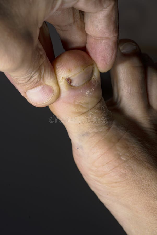 Disease on Human Toes Felon 2024 Stock Image - Image of herpes ...