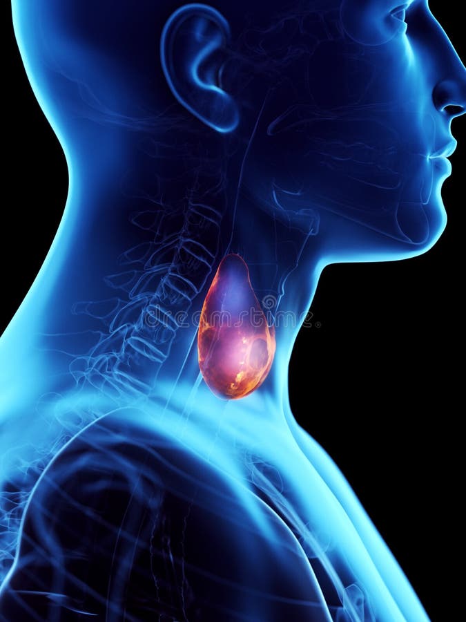 A diseased thyroid gland stock illustration. Illustration of disorder ...