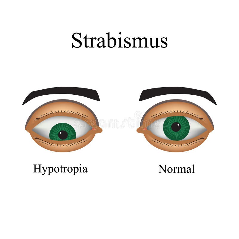Strabismus stock vector. Illustration of esotropia, convergent - 28300621